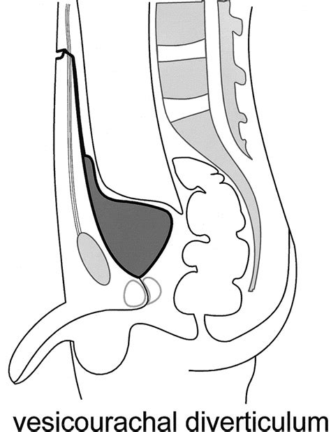 Urachal Remnant Diseases Spectrum Of Ct And Us Findings Radiographics