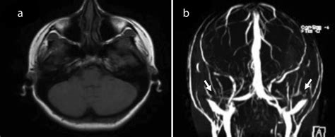 Magnetic Resonance Imaging Mri And Mr Venography Mrv Samples Of A