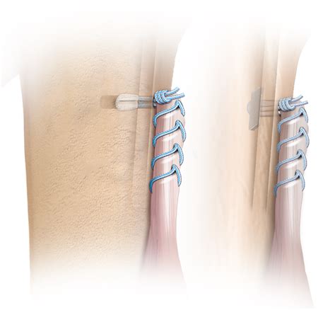 Arthrex Cortical Button Tenodesis Technique