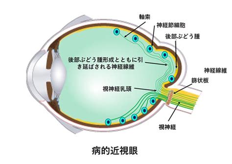 近視から派生する目の疾患を知る Myopia Square（マイオピア スクエア）