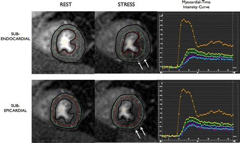 Example Of Subendocardial And Subepicardial Segmentation Rest And Download Scientific Diagram