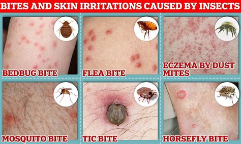 Beware Of Bed Bug Bites How They Can Aggravate Mite Infestations