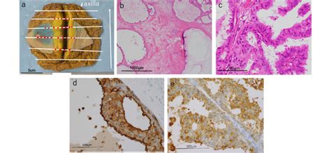 Pathological Findings A Mapping Of Surgical Specimens Red Dots