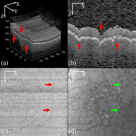 A The Axial Motion Artifacts In 3d Oct Volume Indicated With Red