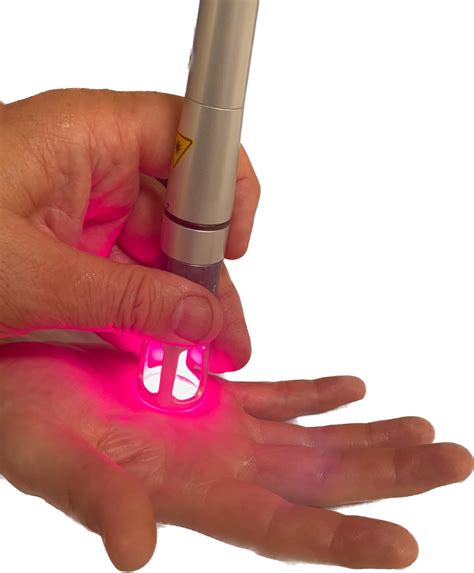 Dupuytren Disease Dupuytrens Contracture Also Known As Dupuytrens Disease Or Vikings Disease