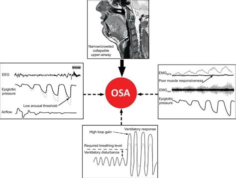 Schematic Of The Anatomical And Non Anatomical Causes Of Osa
