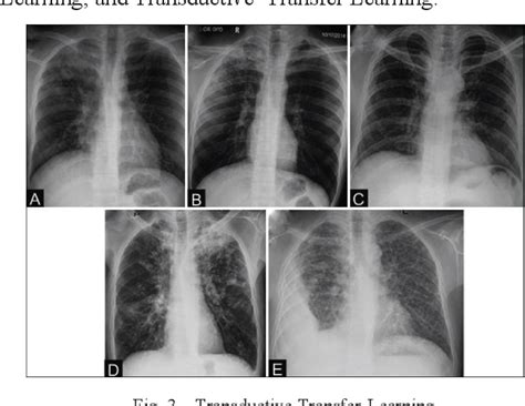 Figure 3 From Detection And Classification Of Tuberculosis Hiv Positive