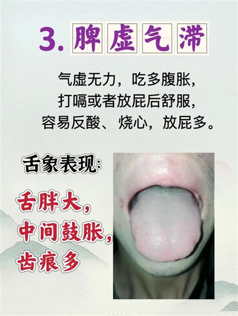 脾虚常见6大舌象，脾气虚、脾胃虚寒、脾虚气滞，你是哪一种？ 哔哩哔哩