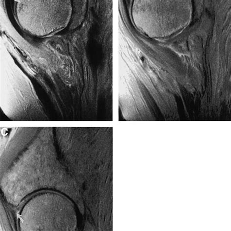 A Sagittal Mri Showing An Intact Anterior Labrum Arrow B