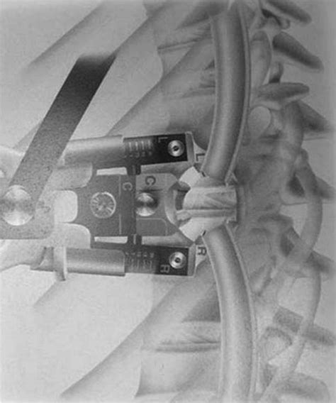 Minimally Invasive Approaches To The Thoracic Spine Neupsy Key