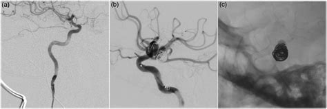 Pipeline Embolization Device Deployment Via An Envoy Distal 49 Off