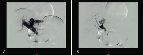 A Digital Subtraction Angiography Of The Liver And B After The Download Scientific Diagram