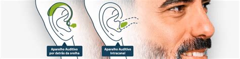 Aparelho Intracanal As Vantagens E Como Funciona