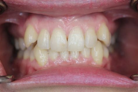 Top Invisalign Provider In NYC Cost Information