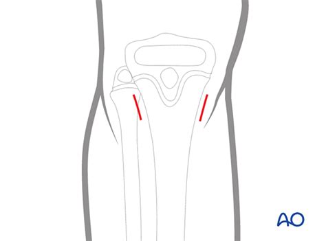 Elastic Nailing For Simple Complete Fracture Of The Distal Tibial Metaphysis