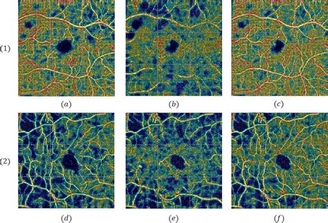 Vascular Density Maps Of Two Patients In Npdr And Pdr Groups Top Row Download Scientific