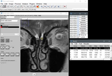 Olfactory Bulb Image Of A COVID 19 Patient Viewing In The ImageJ
