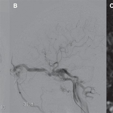 Postoperative Dsa Of The Left Ica A Ap View B Lateral View Of The