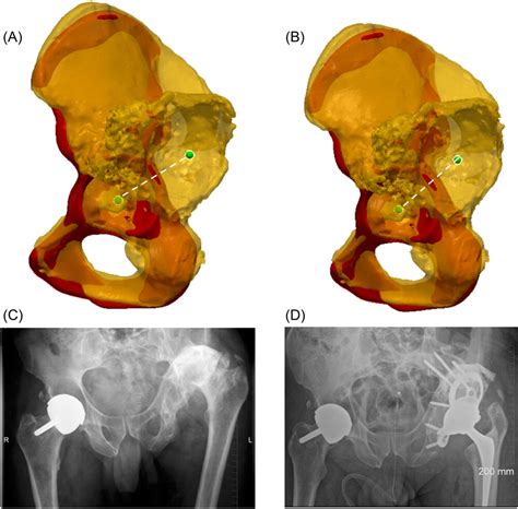 Statistical Shape Modeling Of The Large Acetabular Defect In Hip Revision Surgery De Angelis