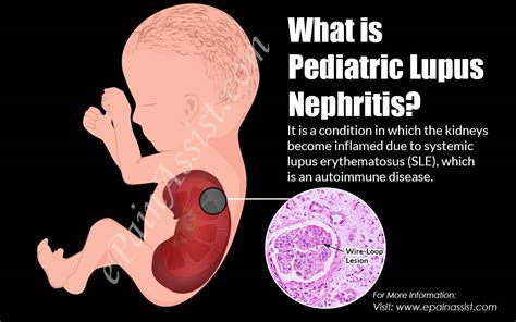 Lupus Nephritis