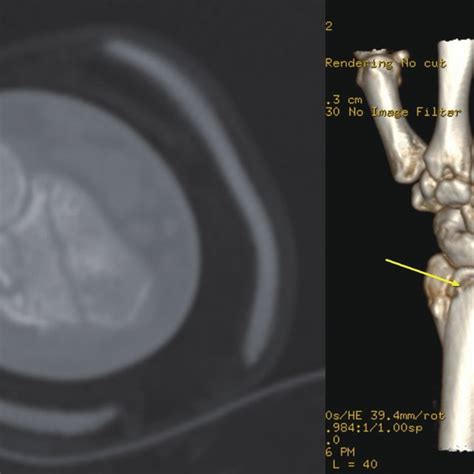 Intraoperative View Of The EIP To EPL Tendon Transfer Using Pulvertaft Download Scientific