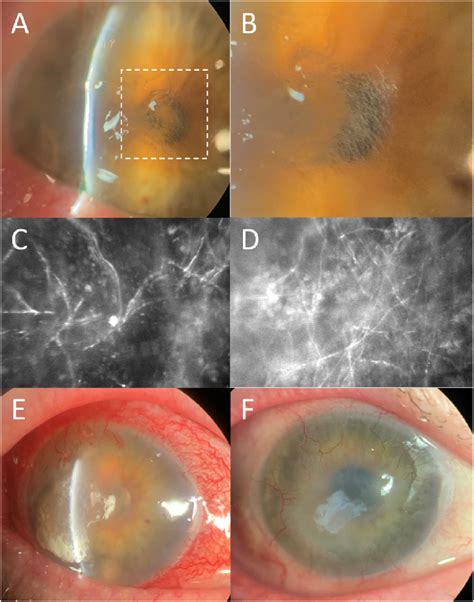 Slit Lamp Photograph Demonstrating Corneal Ulcer With Surrounding