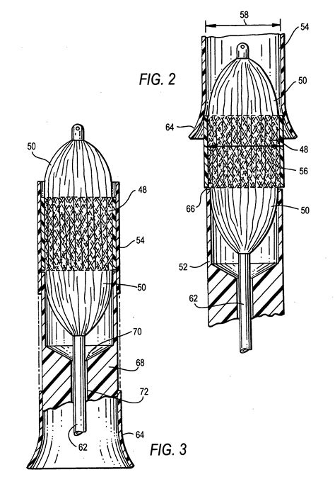Balloon Dilatation Catheter Patented Technology Retrieval Search