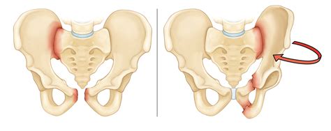 Pelvic Fracture Dr Mukhis Raj Hospital