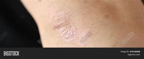 Psoriatic Plaques On Image And Photo Free Trial Bigstock