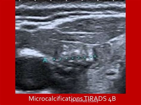 Tirads Thyroid Nodule Imaging Reporting And Data System Dr Ahmed E