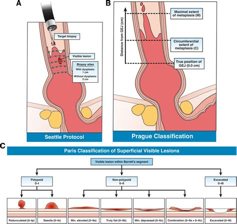 Aga Clinical Practice Guideline On Surveillance Of Barretts Esophagus