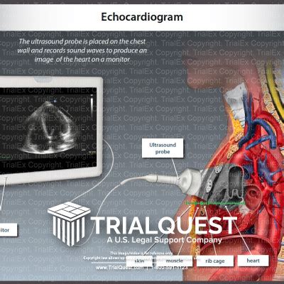 Echocardiogram TrialExhibits Inc