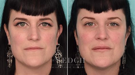 Recessed Maxilla How To Fix Before And After