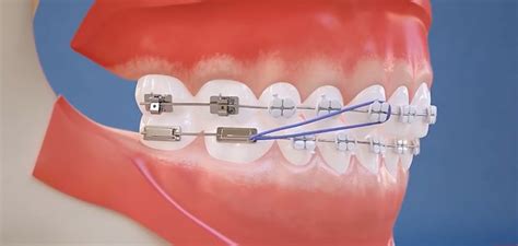 VIDEO How Do Braces Work Like Really Fort Worth Dentist 7th Street District H
