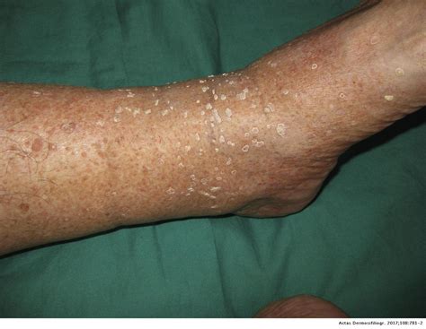 Hyperkeratosis