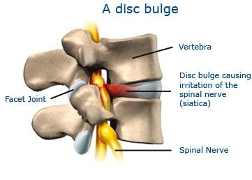 Myo Therapy Healthcare Institute When You Have A Bulging Disc How To Safely Practice Yoga