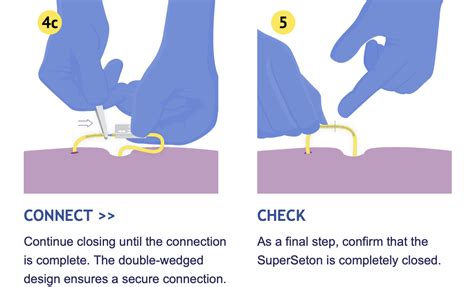 Smooth Simple Secure Treating Fistulas The Easy Way Superseton
