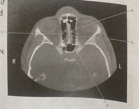 Ct Of Ethmoid Bone Quiz