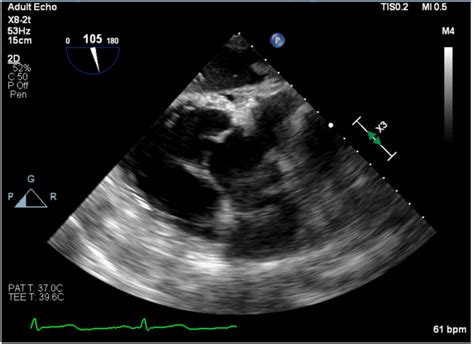 Transgastric Right Ventricular Inflow Tee View Demonstrating