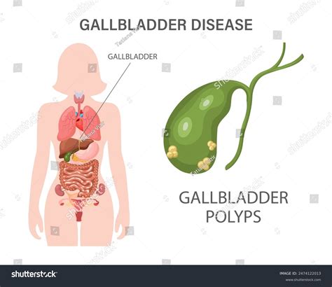 Gallbladder Diseases Infographic Banner Gallstone Disease Stock Vector