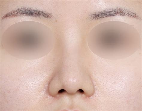콧대히알라제필러녹임 3d맞춤보형물 귀연골 비중격연골 기능코2종 전후사진 아베크성형외과