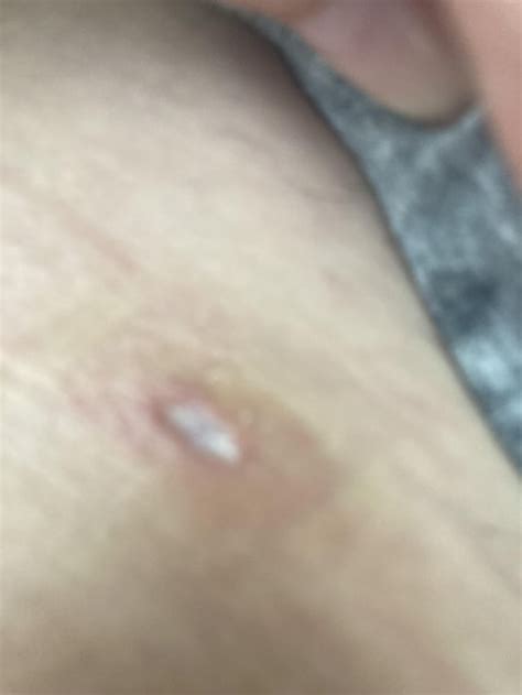 48hr Post Biopsy R Dermatologyquestions