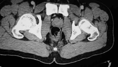 A Ct Scan Performed On The Patient Revealed Mild Soft Tissue Defect Download Scientific Diagram