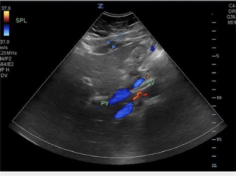 The Ultrasound Of The Right Upper Quadrant Of The Abdomen Shows