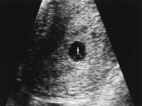 Obstetric Ultrasound First Trimester Radiology Key