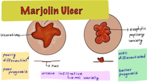 Marjolin Ulcer Definition Etiology Clinical Feature Diagnosis And