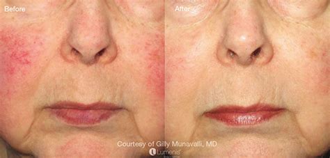 Rosacea Main Street Skin Clinic