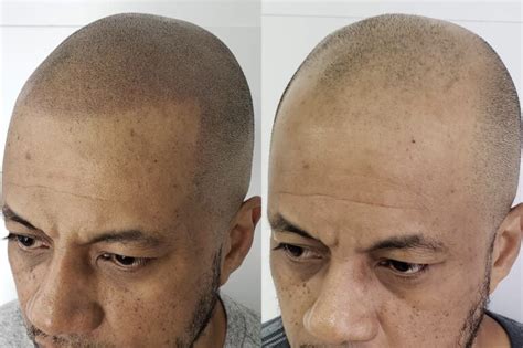Discover The Benefits Of Scalp Micropigmentation Bites For Health