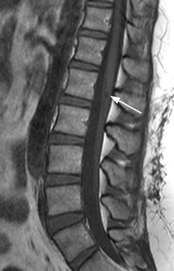 Ventriculus Terminalis Radsource