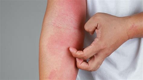 Different Types Of Rashes FAQs